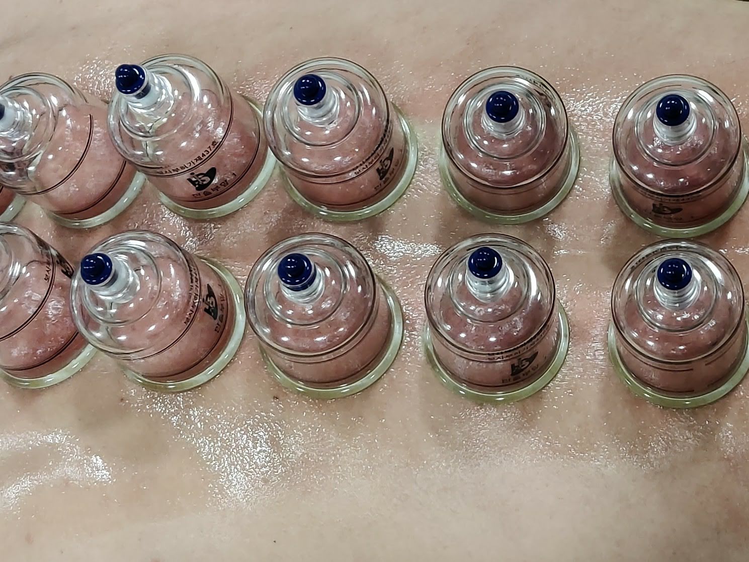 Cupping Therapy: Ancient Healing for Modern Wellness
